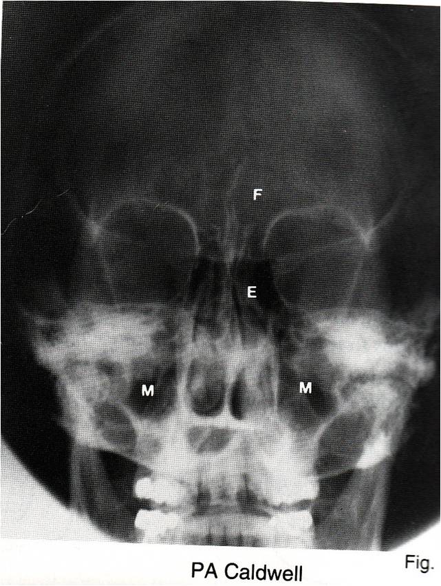 Catatan Ku: Teknik Radiografi Sinus Paranasal