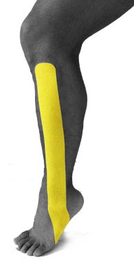 ARES Kinesiology Tape: Shin Splint