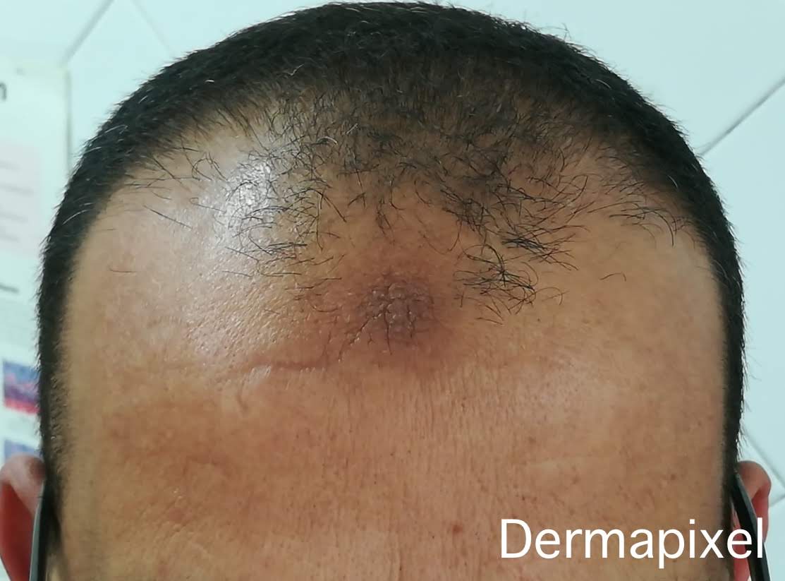 Dermapixel: mayo 2020