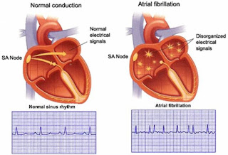 Irregular Cardiovascular system Rhythms (arrhythmias) - Alternative ...