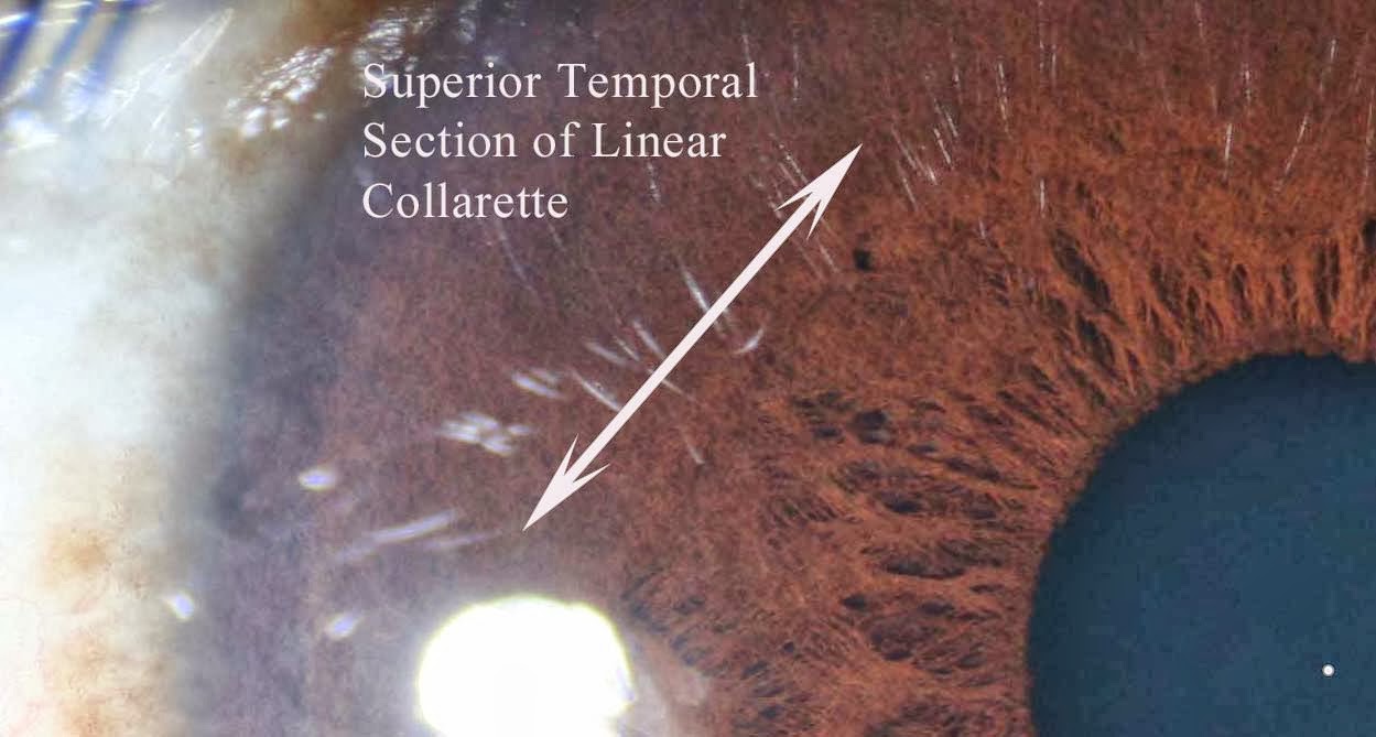 Modern & Multidimensional Iridology: Stairstep Lacuna & The Collarette ...