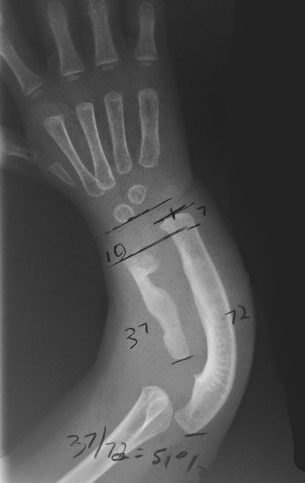 Type 2 Radial Longitudinal Deficiency | Congenital Hand and Arm ...
