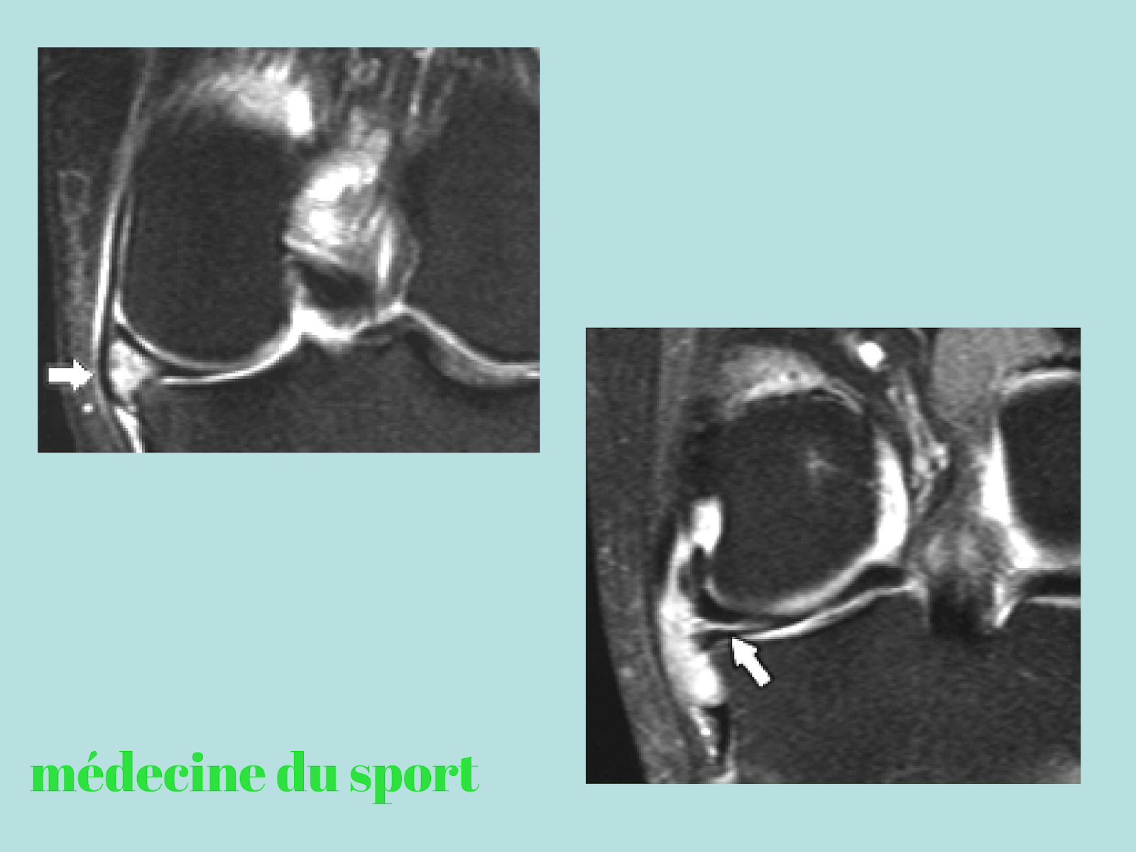 IMAGERIE DU GENOU APPLIQUÉE A LA PATHOLOGIE SPORTIVE