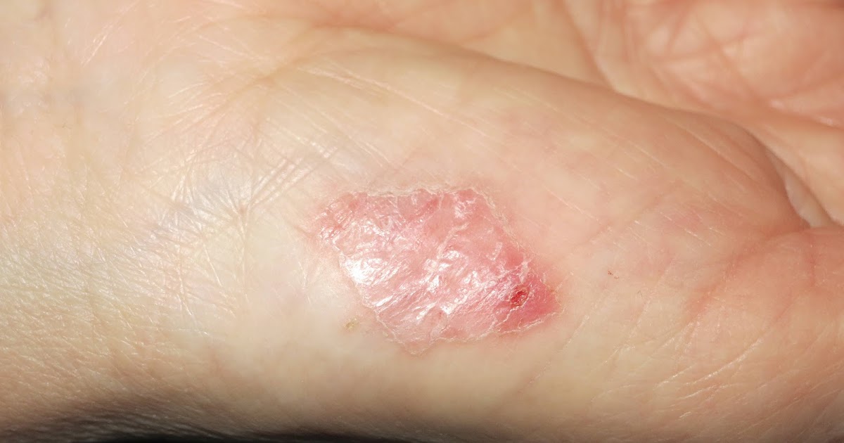 Dermapixel: Hipoqueratosis palmar circunscrita: vista una, vistas todas