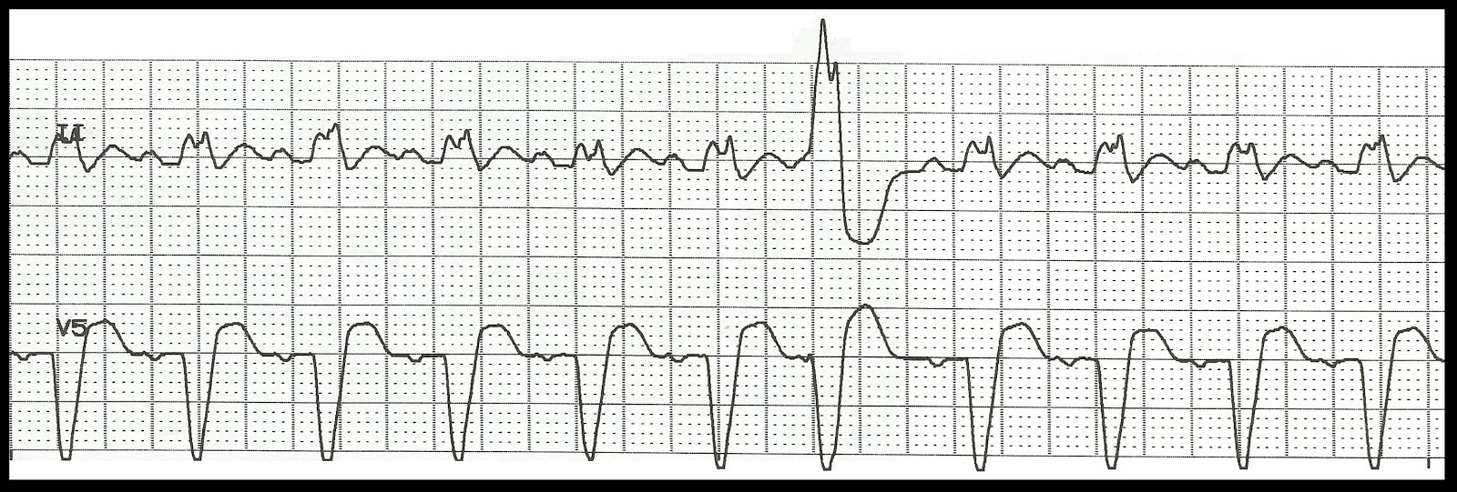 Practice ECG Rhythm Strips 112