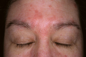 Seborrheic Dermatitis - Scalp Pictures, Causes, Treatment