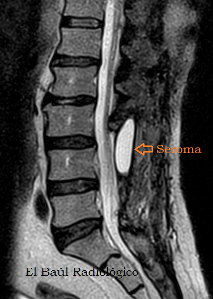 El Baúl Radiológico: SEROMAS POSTQUIRÚRGICOS PARAVERTEBRALES (Lumbar ...