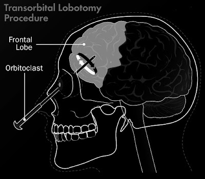 THE CONTROVERSIAL NEUROSURGERY: TRANSORBITAL LOBOTOMY
