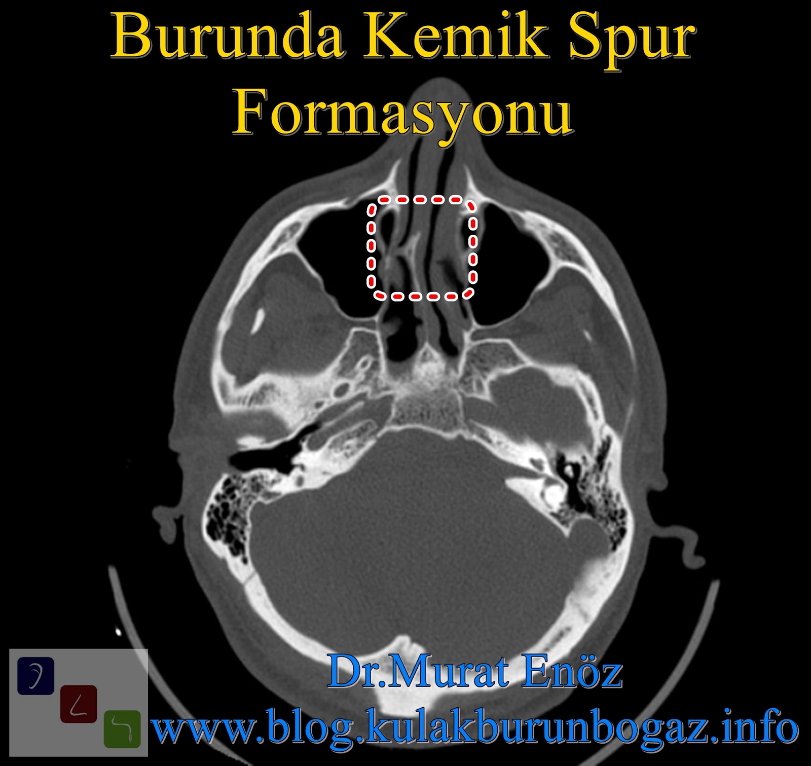 Ossified Overhang (Osteophyte) In The Nose That Can Cause Atypical ...