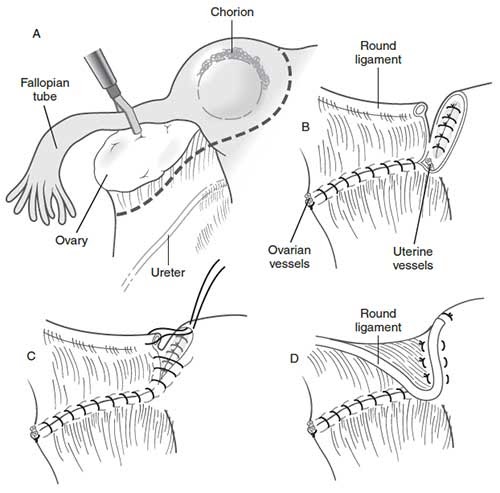 Ectopic Pregnancy—Laparotomy Case File
