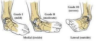 Pengertian Cedera Olahraga Definisi Macam Pecegahan dan Perawatan ...