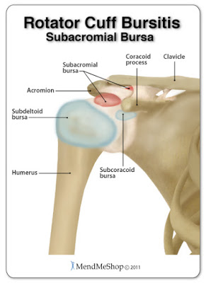 Subacromial Bursitis and its Physiotherapy Intervention