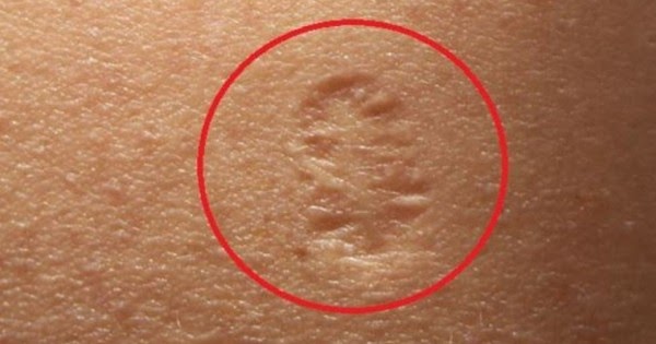 Awesomequotes4u.com: Do You Know the Truth Behind The Small Scar On ...