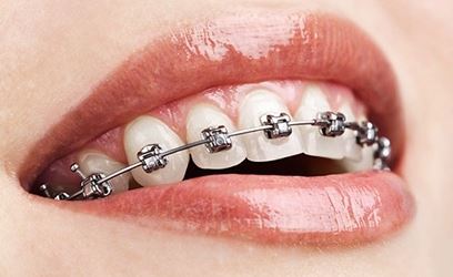 The Concept of the Straight Wire Appliance in Orthodontics