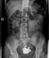Técnicas y procedimientos de Enfermería: EXTRACCIÓN FECALOMA O ...