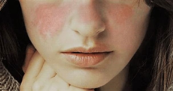 Kenali Penyebab, Tanda dan Gejala Penyakit Lupus Serta Bahayanya - Part ...