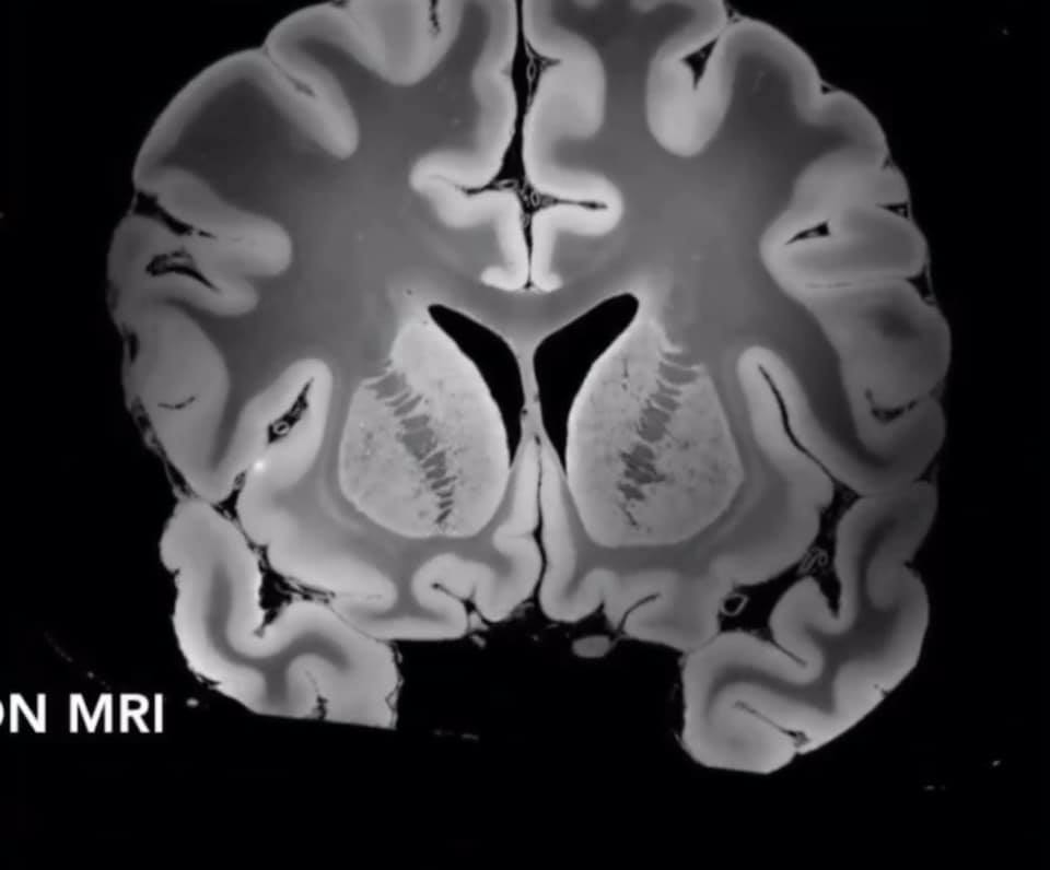 100 micron Brain Section on 7 Tesla MRI - Sumer's Radiology Blog