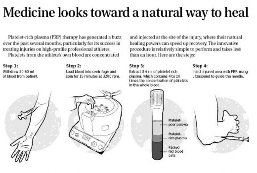 Journal Of A Princess..: Autologous Conditioned Plasma (ACP) Injection
