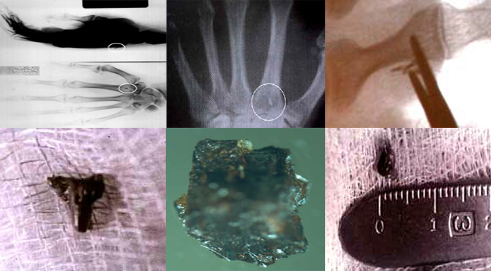 Implantes extraterrestres y Nanotecnología Doctor Roger K. Leir ...