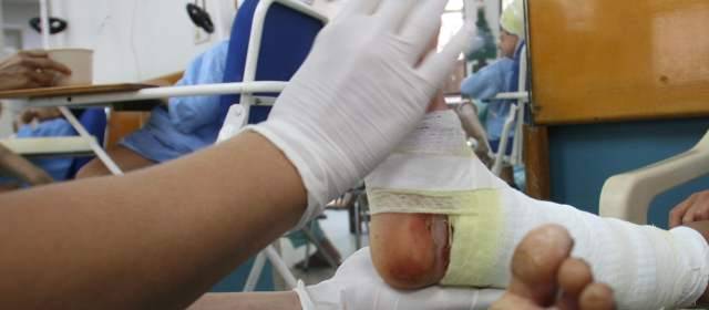 Manejo de Fisioterapia en pacientes quemados ~ Fisioterapia