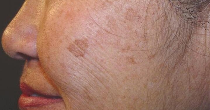 Here Is A 2 Ingredient DIY Remedy For Getting Rid Of Brown Spots On Your Skin here-is-a-2-ingredient-diy-remedy-for-getting-rid-of-brown-spots-on-your-skin