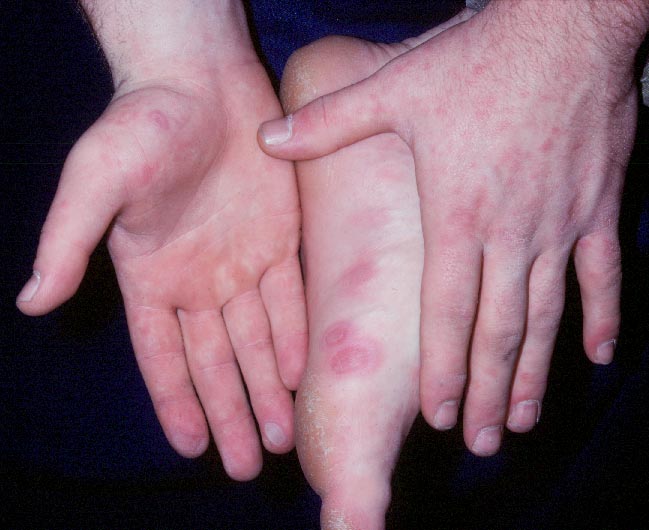 Internet Clinic: Detailed Awareness Campaign On Enteroviral Infection