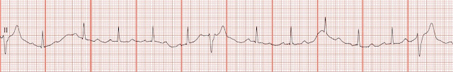 ECG Rhythm Strip Quiz 77
