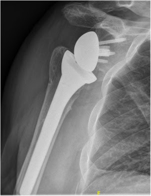 Revisiones_bibliográficas TyO_Web: Notching escapular en las prótesis ...