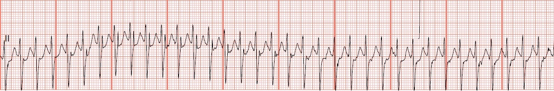 EKG Rhythm Strips 68
