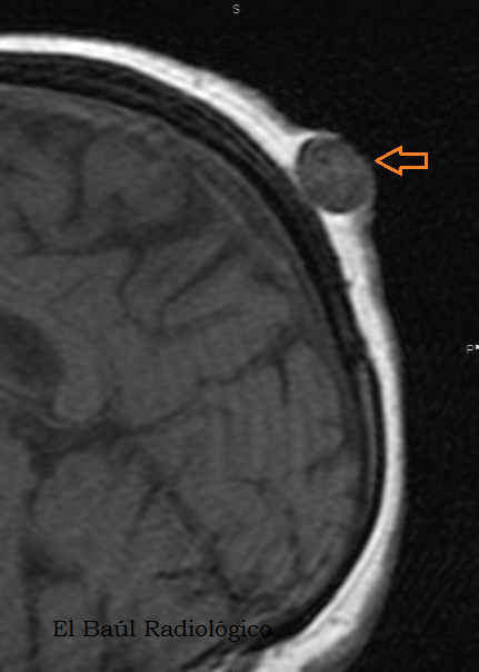 QUISTES SEBÁCEOS CALCIFICADOS DEL CUERO CABELLUDO (CALCIFIED SEBACEOUS ...