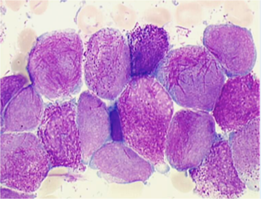 LEUCEMIE AIGUË MYELOBLASTIQUE(LAM) - BIOLOGIE MEDICALE