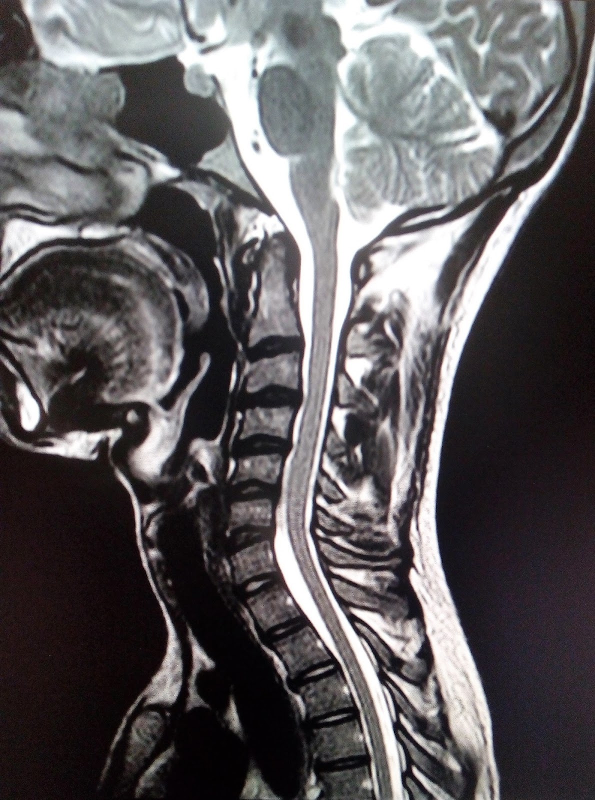 Chronic inflammatory demyelinating polyradiculoneuropathy (CIDP): MRI - Sumer's Radiology Blog