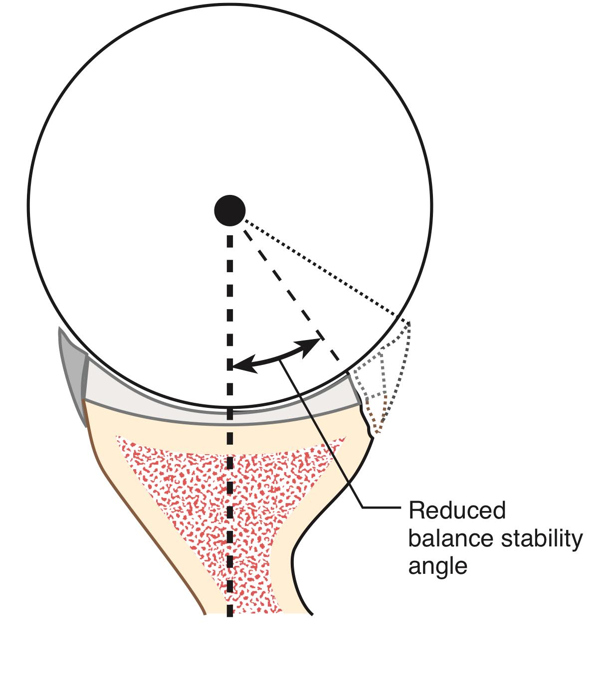 UW Shoulder and Elbow Academy: The normal shoulder, aTSA, and RSA are ...