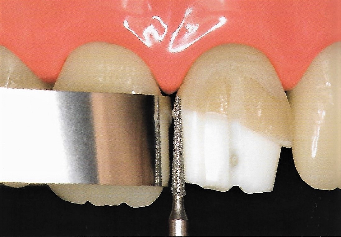 Anterior Crown Preparation | Dental Esthetics