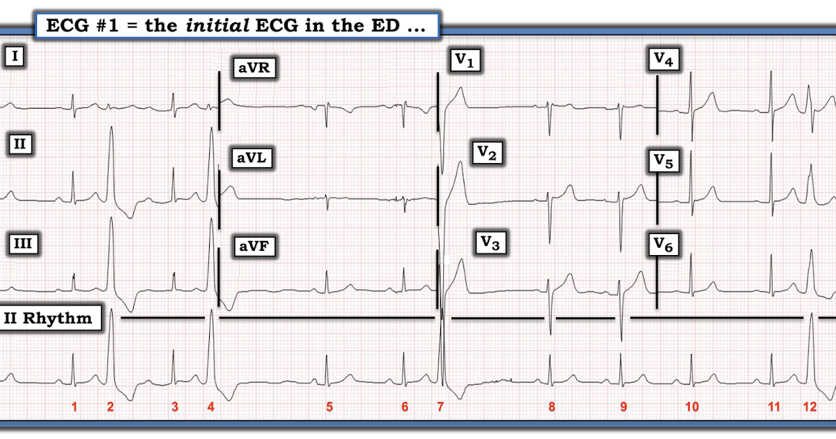 ECG Interpretation: ECG Blog #176 (PVCs - interpolated - AV block ...