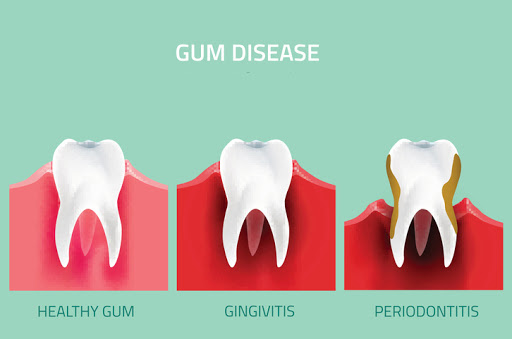 Is Gum disease causes heart attacks?
