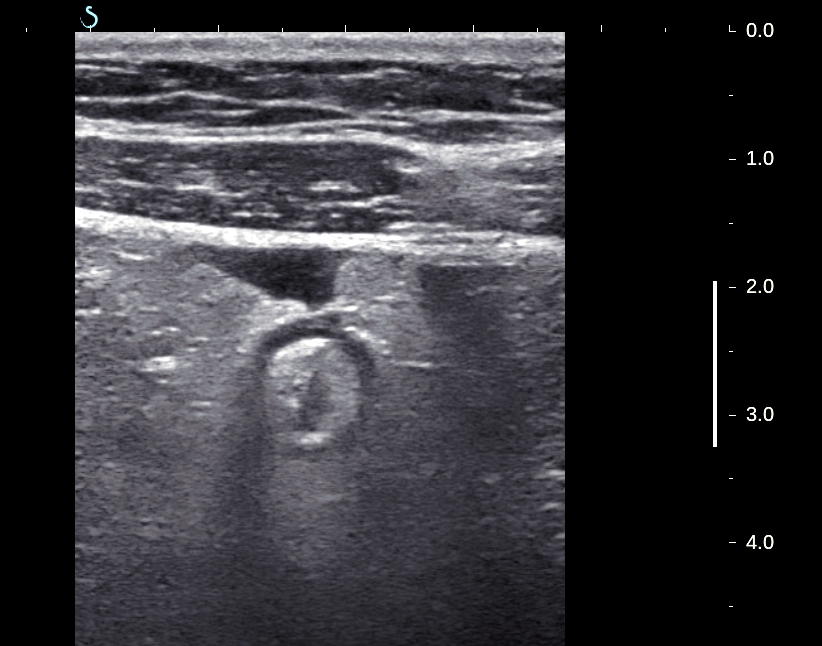 VIETNAMESE MEDIC ULTRASOUND: CASE 389: ECTOPIC APPENDICITIS, Dr PHAN ...