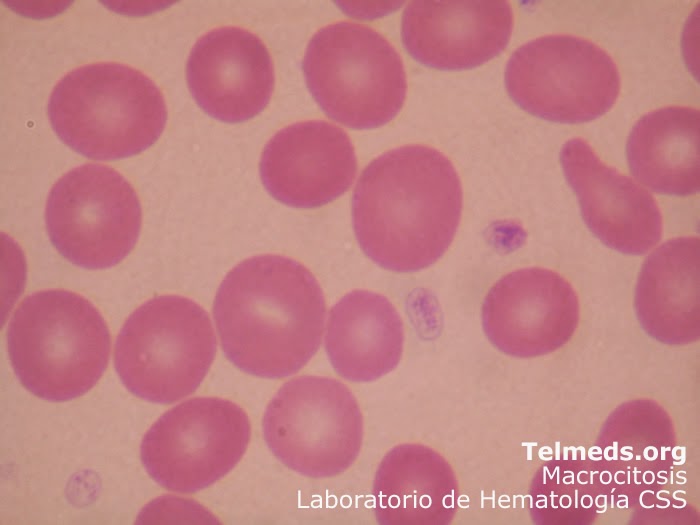 FICHERO DE HEMATOLOGIA: MACROCITOSIS