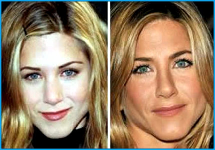 Celebrities Plastic Surgery