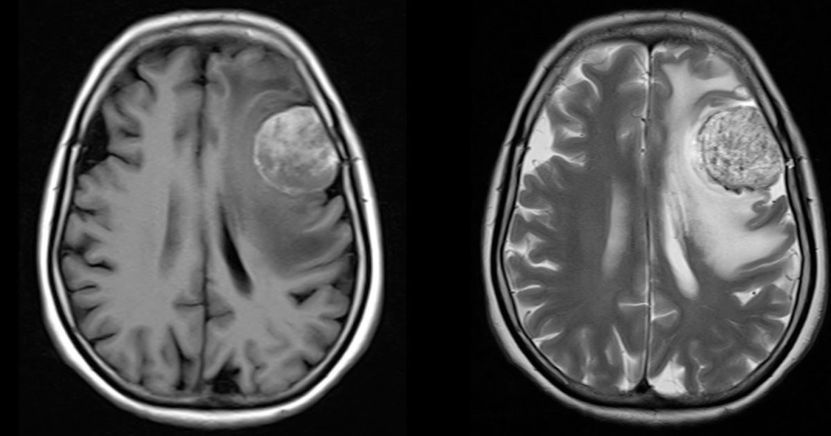 hemorrhagic brain metastases lung cancer Ultimate radiology ...