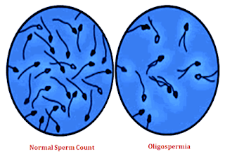 Mohak Infertility Center: OLIGOSPERMIA : ITS CAUSES SYMPTOMS AND TREATMENT