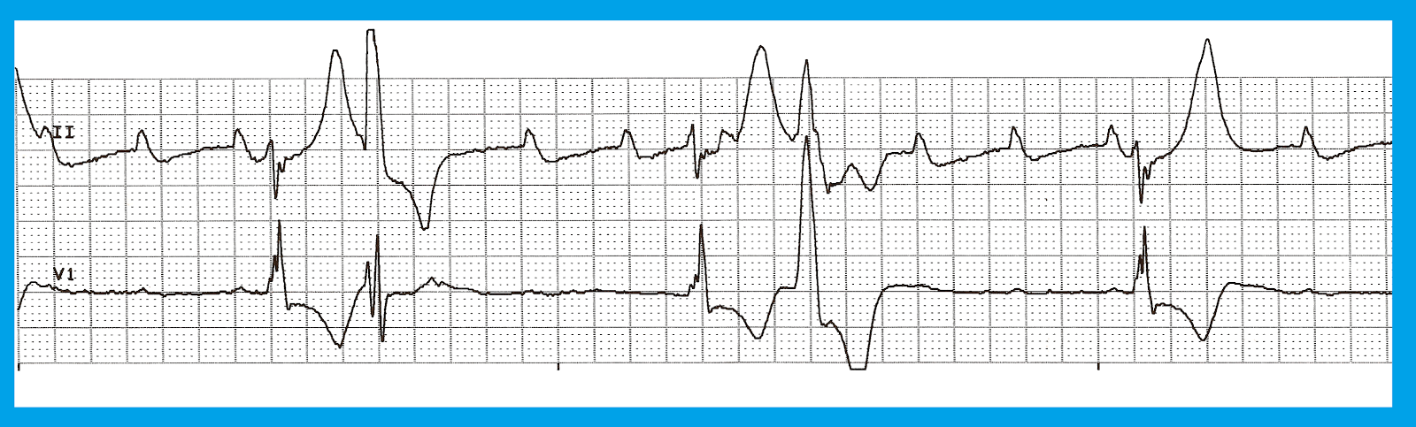 Basic EKG Rhythm Test 21 (Heart Block Challenge)