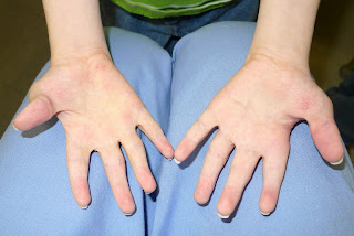 The Thumb in Arthrogryposis | Congenital Hand and Arm Differences ...
