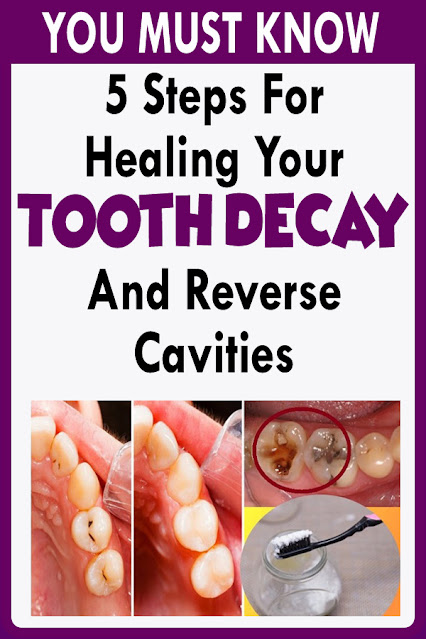 5 Steps For Healing Your Tooth Decay and Reverse Cavities - Healthy ...