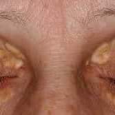 Xanthomas Plane Planar Xanthoma Palmar Xanthoma