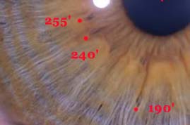 Modern & Multidimensional Iridology: Crypts & Radial Furrow at ...