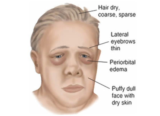 Nephrotic Syndrome , Definition, Sign and symptoms, cause.....
