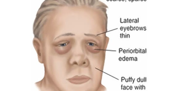 Nephrotic Syndrome , Definition, Sign and symptoms, cause.....