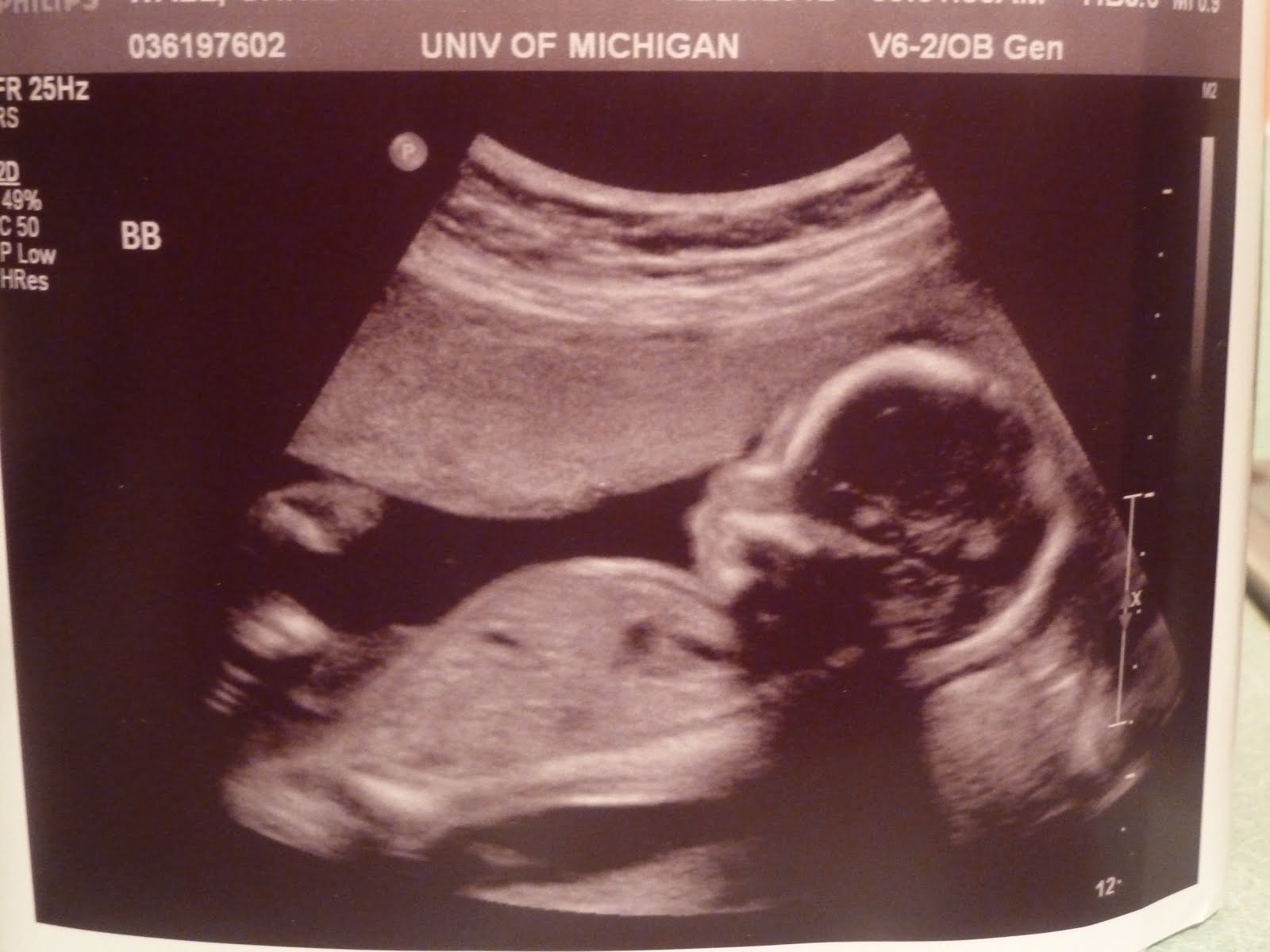 Baby Bitty Twins: 18 week ultrasound pics