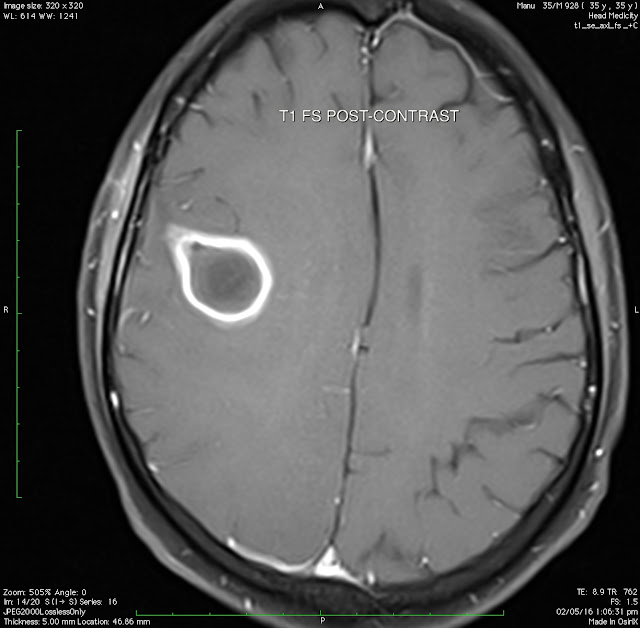 Ultimate Radiology : Frontal lobe abscess : follow up MRI